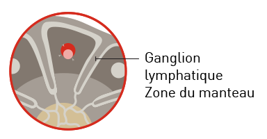 Symptômes du lymphome à cellules du manteau | Lilly France
